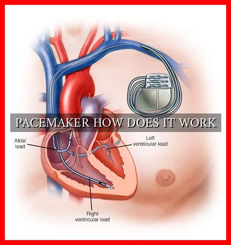 PACEMAKER HOW DOES IT WORK - Wadaef