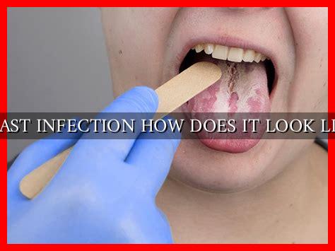 YEAST INFECTION HOW DOES IT LOOK LIKE - Wadaef