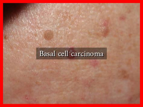 Basal cell carcinoma - Wadaef